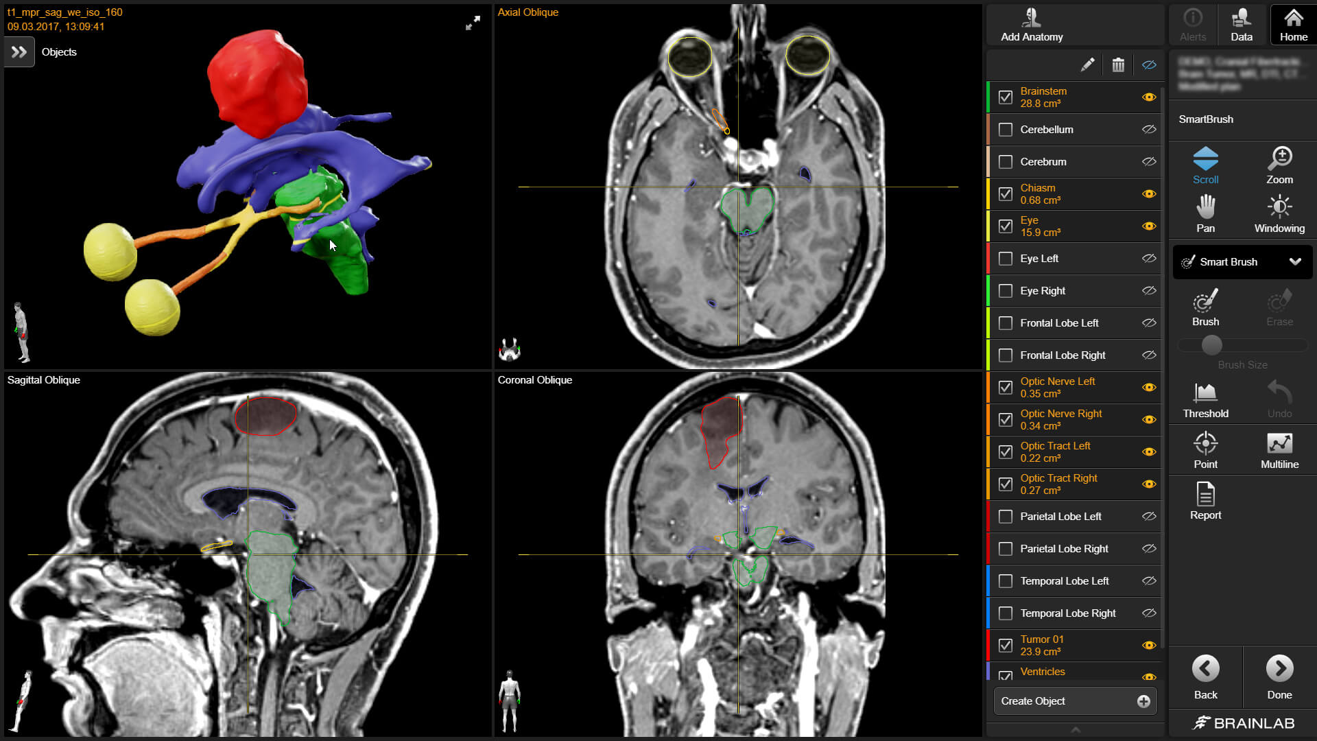 Kraniale Planung mit den Elements | Brainlab